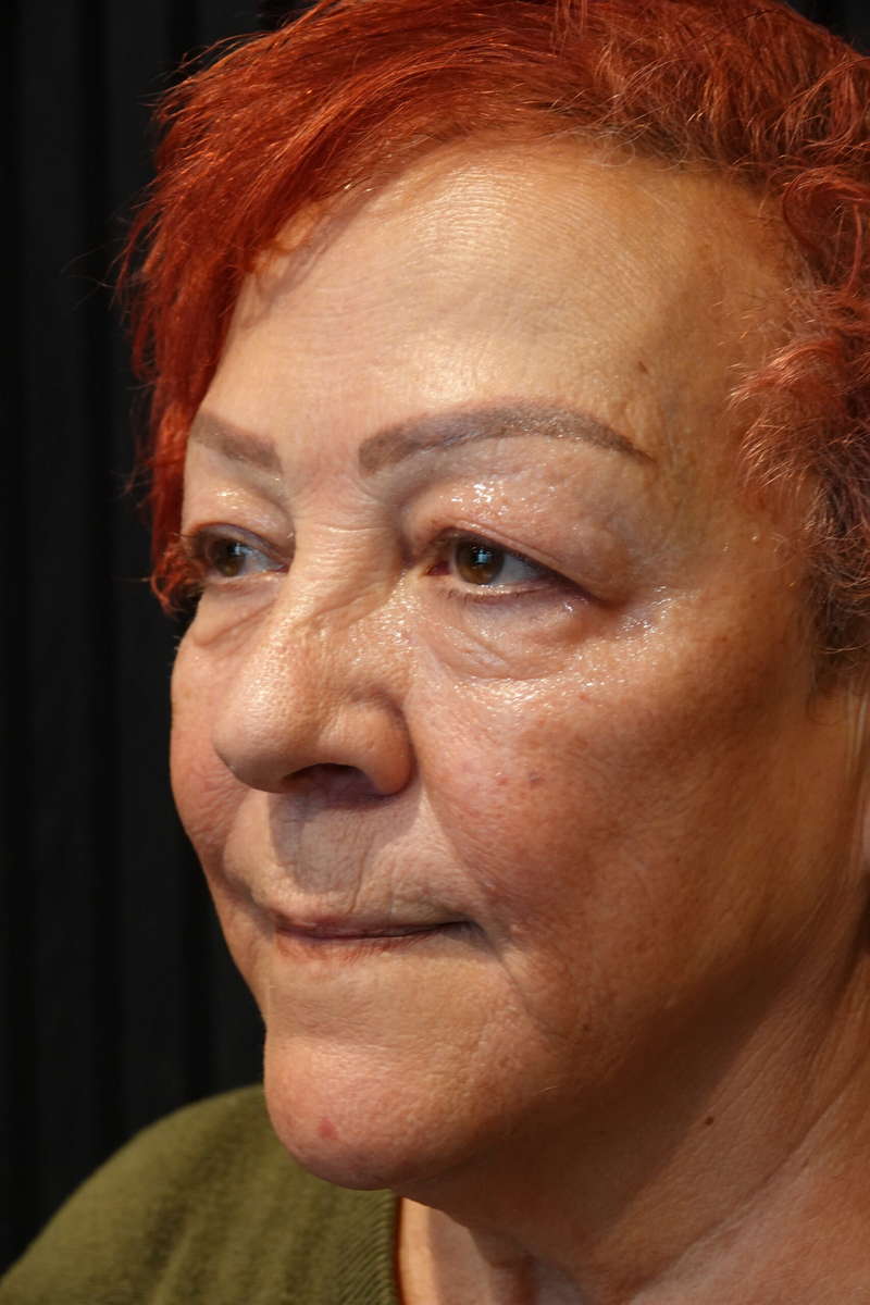 Non-Surgical Blepharoplasty - Dr SW Clinics