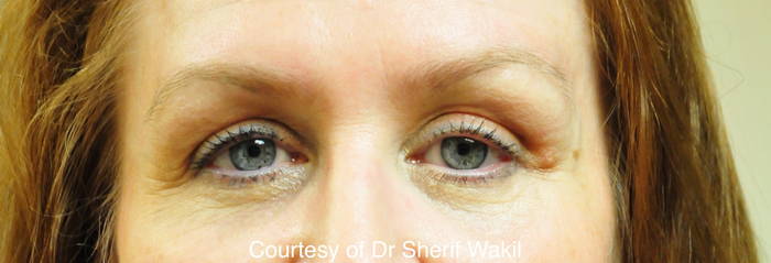 Non-Surgical Blepharoplasty - Dr SW Clinics