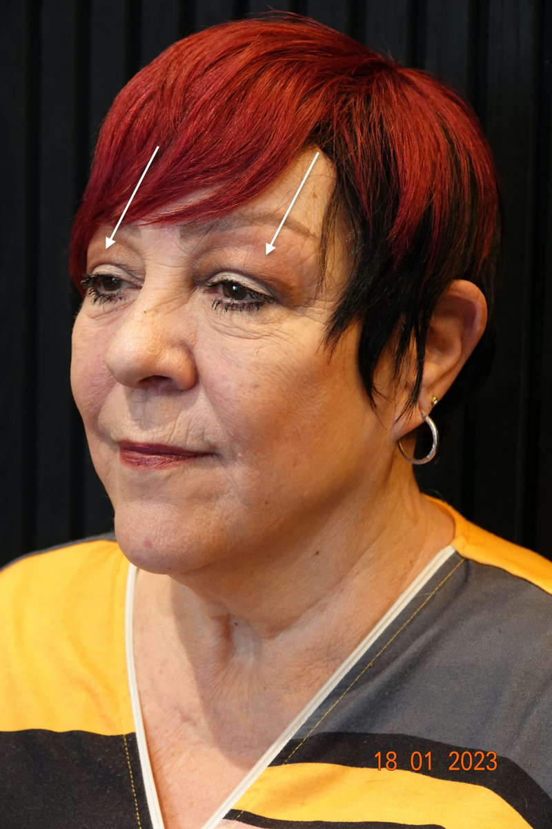 Non-Surgical Blepharoplasty - Dr SW Clinics
